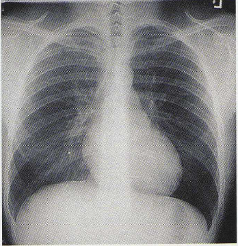 Teknik Pemeriksaan Radiografi Thorax Proyeksi PA | Radiologi