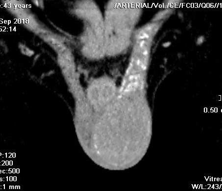 VIETNAMESE MEDIC ULTRASOUND: CASE 512: TESTICULAR TUMOR, Dr PHAN THANH ...