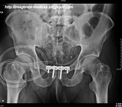 Sobre técnicas de imágenes médicas (Blog STIM): Radiografias de Pelvis ...