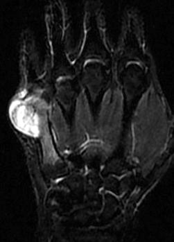 BPOP versus differentials - Sumer's Radiology Blog