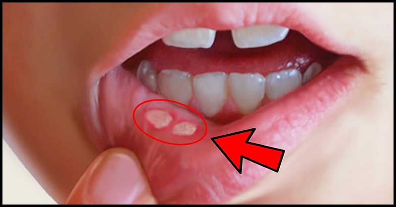 Canker Sores And Its Home Remedies | Dr Farrah MD