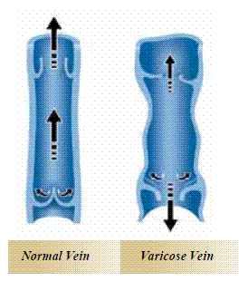 Donna: 1470nm Diode Laser for GSV Treatment