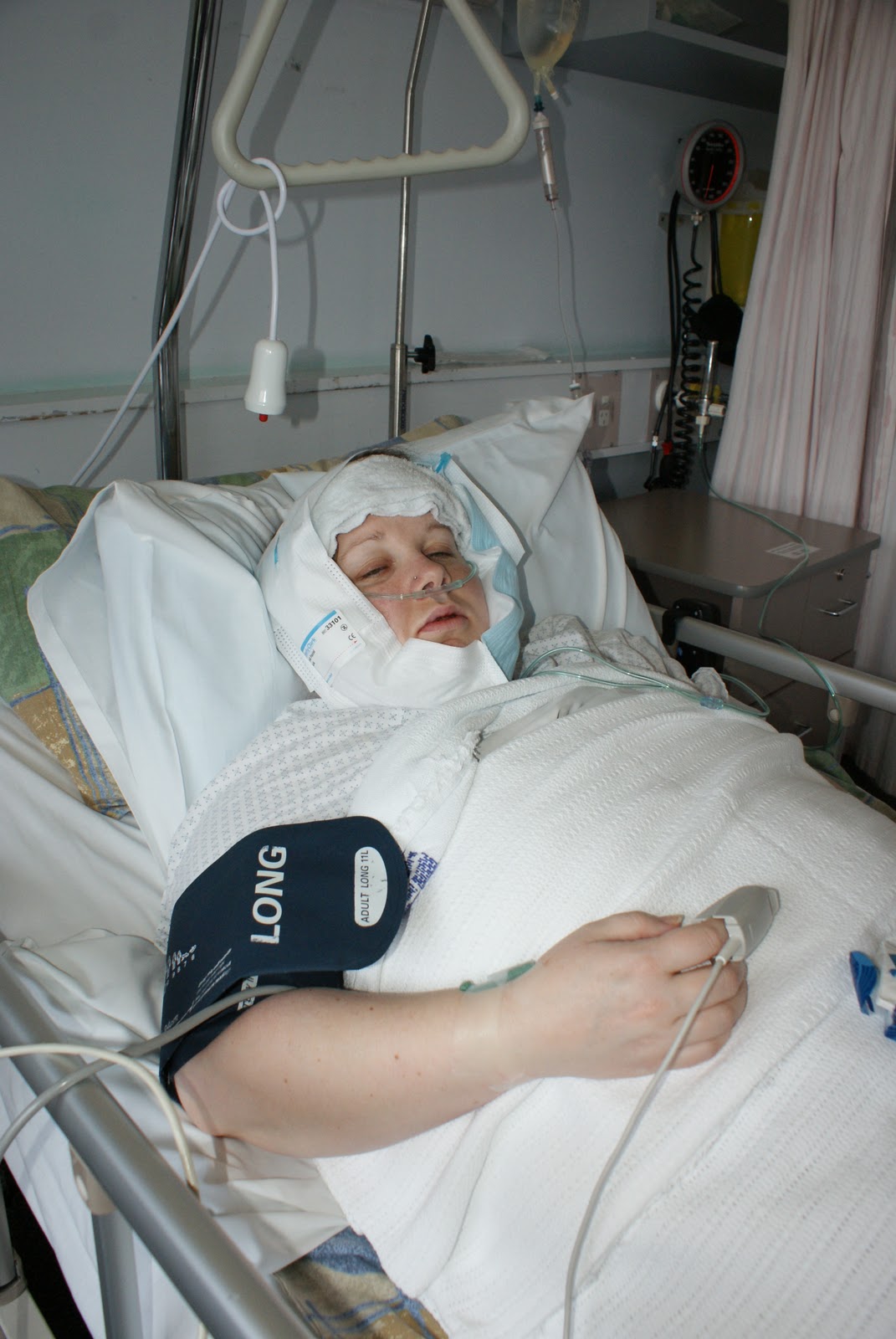 Braces + SARPE/SARME Surgery: SARPE/SARME Surgery