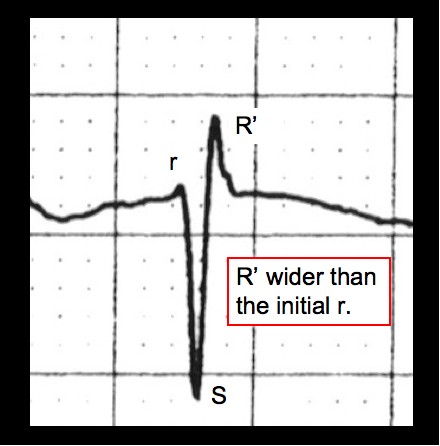 Cardiac Nurse: Teaching As I Learn: Defining Incomplete Right Bundle ...