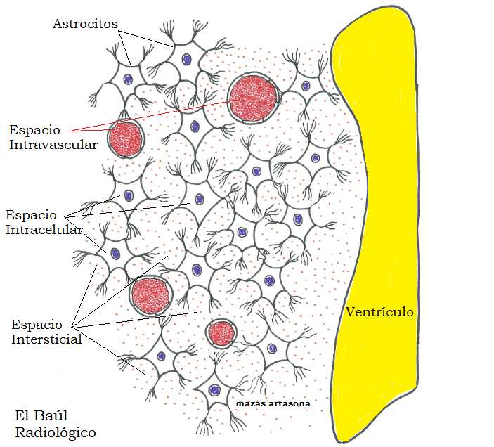 El Baúl Radiológico: EDEMA DEL SISTEMA NERVIOSO CENTRAL (Edema in the ...