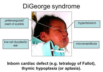 Pediatrics Notes: Introduction to DiGeorge Syndrome