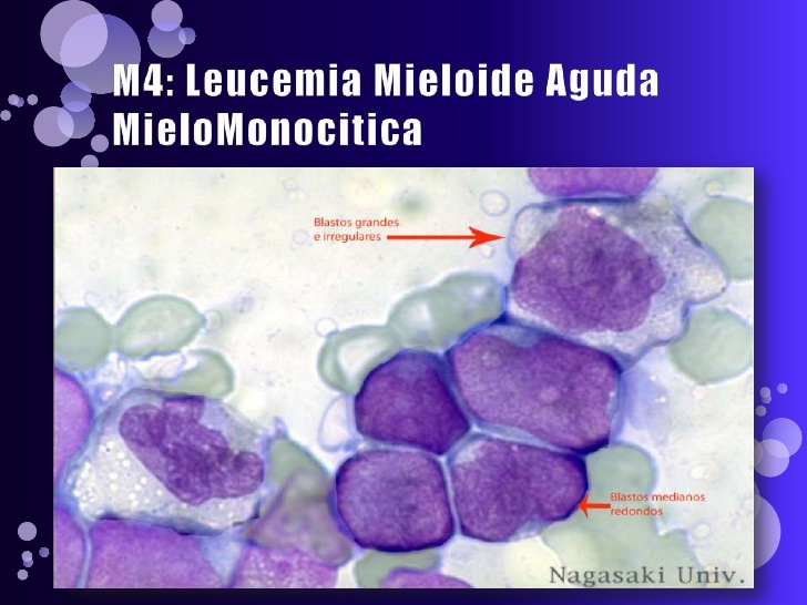 Células Sanguíneas: Leucemias Mieloides Agudas