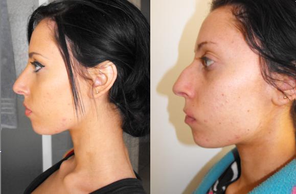 My rhinoplasty Diary: 2 weeks post op