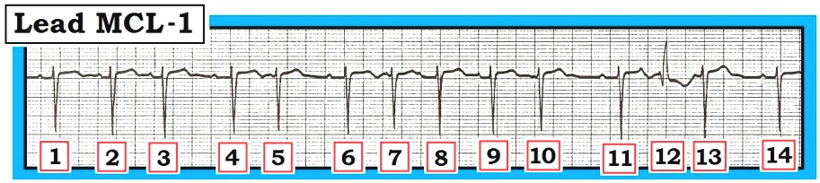 ECG Interpretation: ECG Blog #70 (PVC – Aberrancy – Ashman)