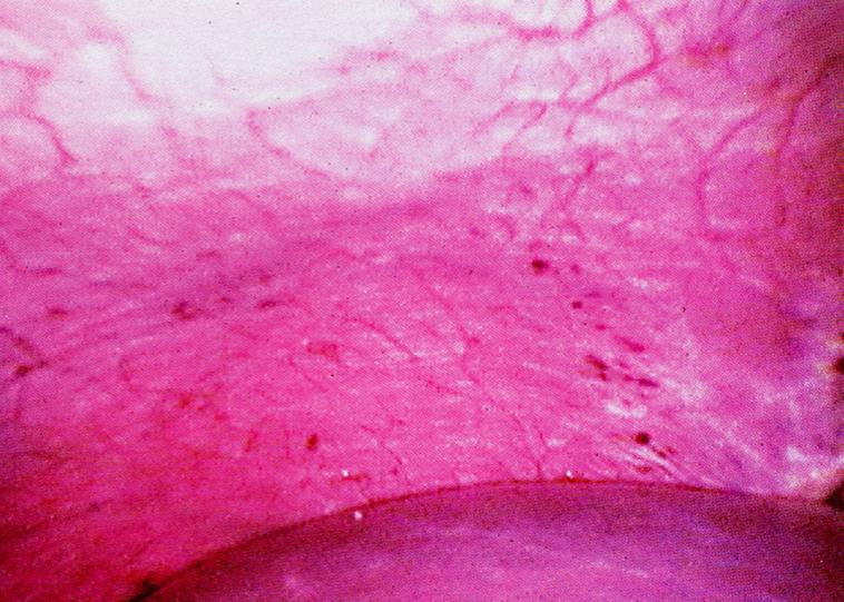 A Endometriose e Eu: DAVID REDWINE: DIAGNÓSTICO LAPAROSCÓPICO DA ...