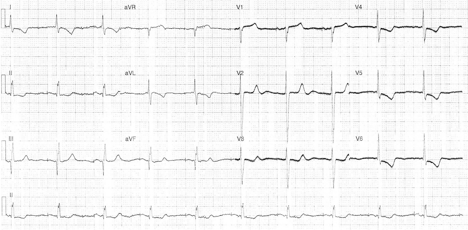 ECG of the Week: ECG of the Week - 15th February 2016 - Interpretation