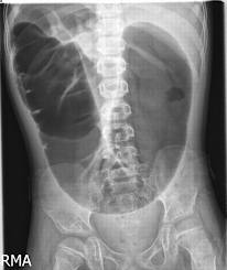 My Radiology World: Volvulus