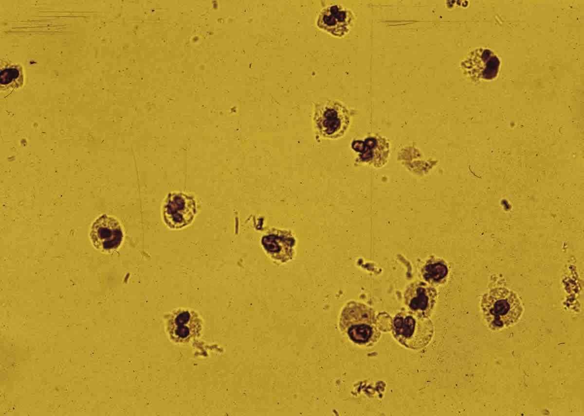 Piócitos Raros Na Urina - RETOEDU