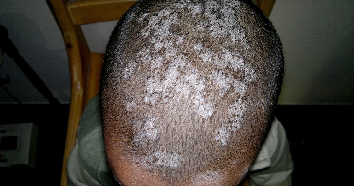 Tinea capitis || Med-koM