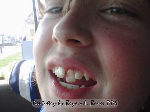 Tooth knocked out?- Knocked out tooth - What to do - Bauer Smiles