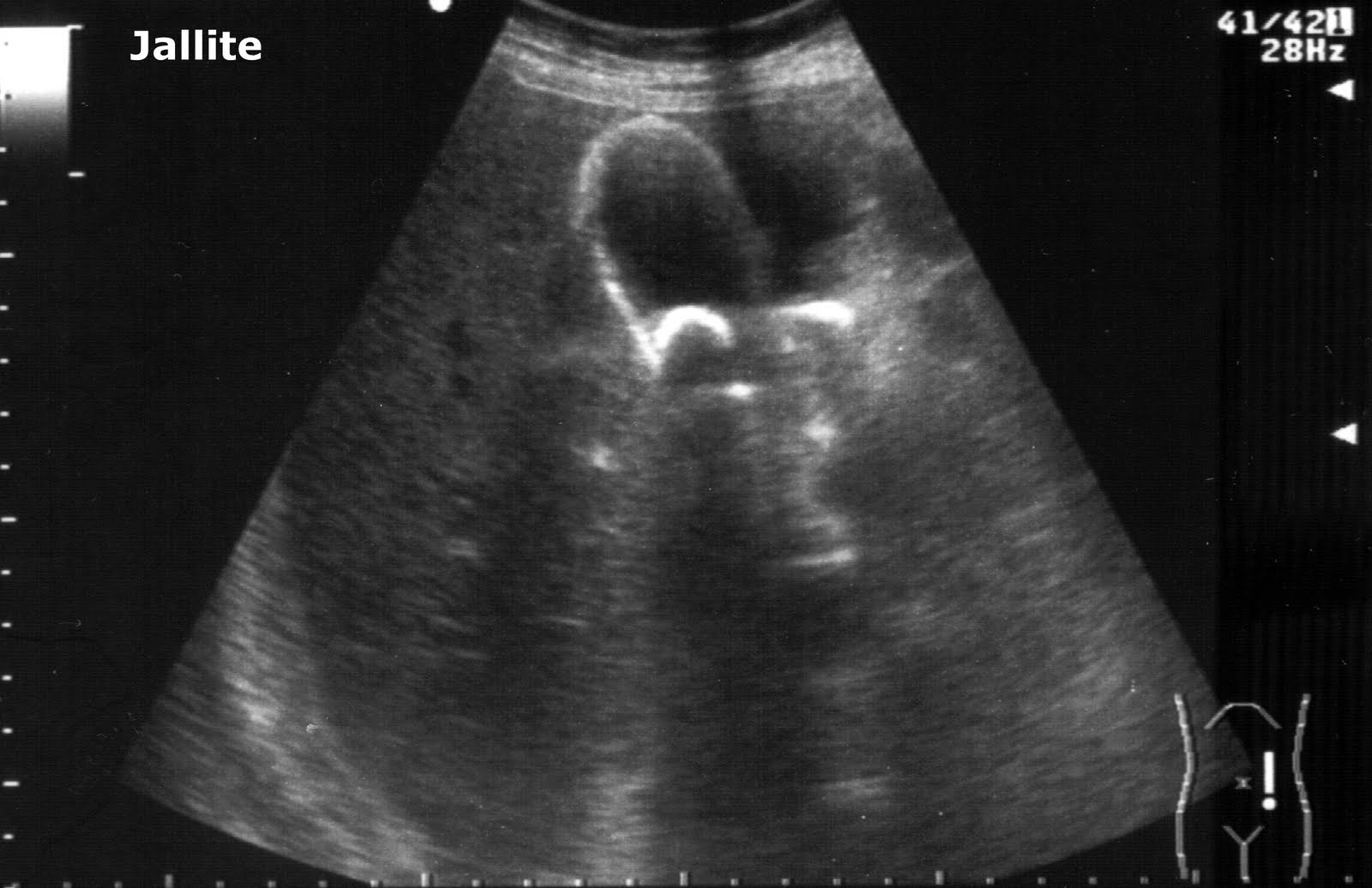 Hernia Umbilical y......