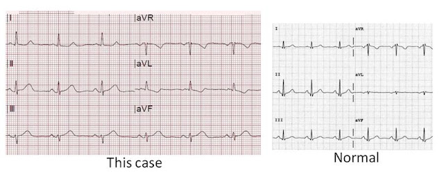 Dr. Smith's ECG Blog: 10 Cases of Inferior Hyperacute T-waves
