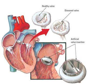 Medical Treatment in India: Cardiac Valve Replacement Surgery at Top ...
