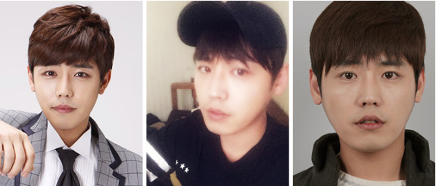 ID Hospital Korea: Korean guy experiencing v line surgery and cheekbone ...