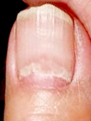 Onychomadesis Causes and Treatment for Children and Grown Ups