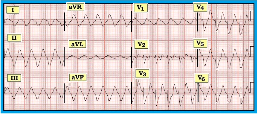 ECG Interpretation: ECG Interpretation Review #52 (Wide Tacycardia ...