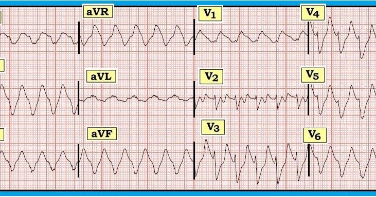 ECG Interpretation: ECG Interpretation Review #52 (Wide Tacycardia ...