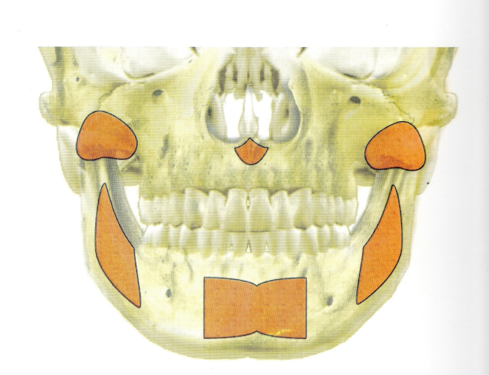 Implantes Dentales Costa Rica - Cima San José y Heredia