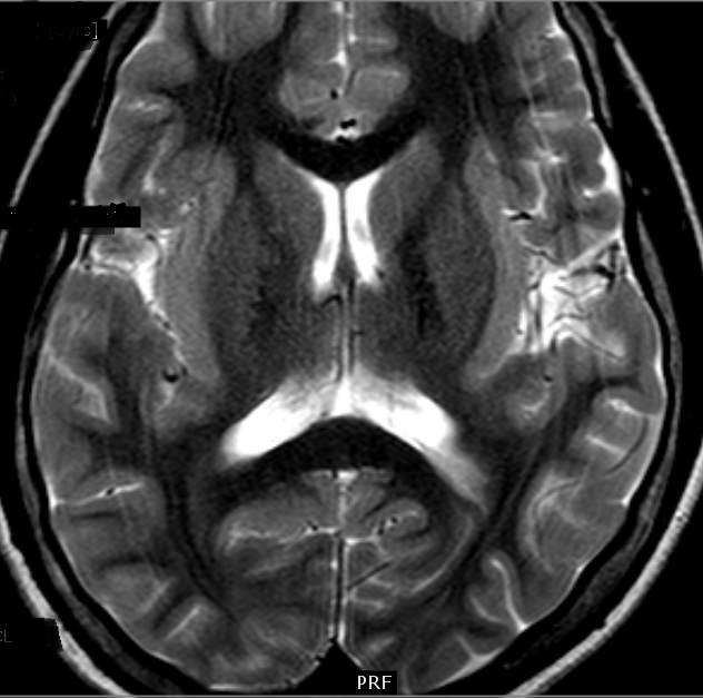 Polymicrogyria-Teaching Points - Sumer's Radiology Blog