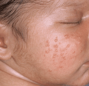 Baby Pimples | Infant and Babies Acne: How to get rid of Infant Pimples