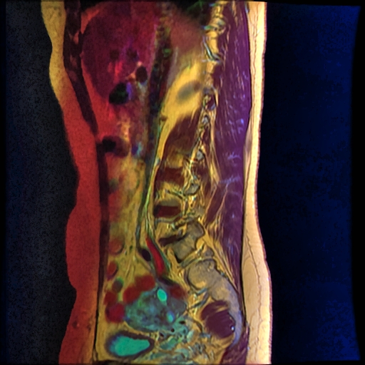 Nevit's blog: Color MRI of the Lumbar spine with extruded disc