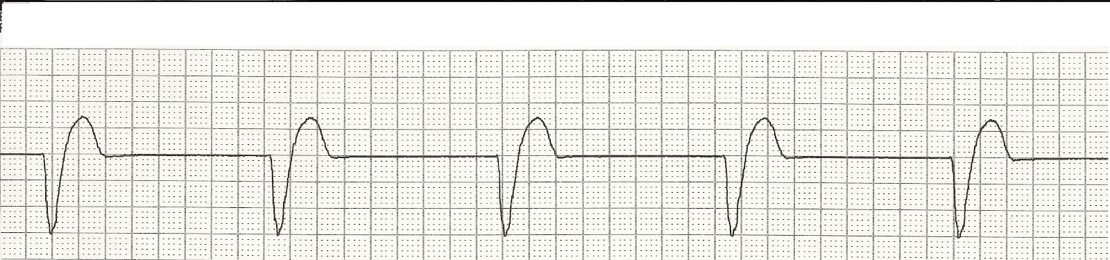 ACLS Rhythms: Ventricular rhythms