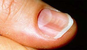 Nails and Your Health | Nurselk.com