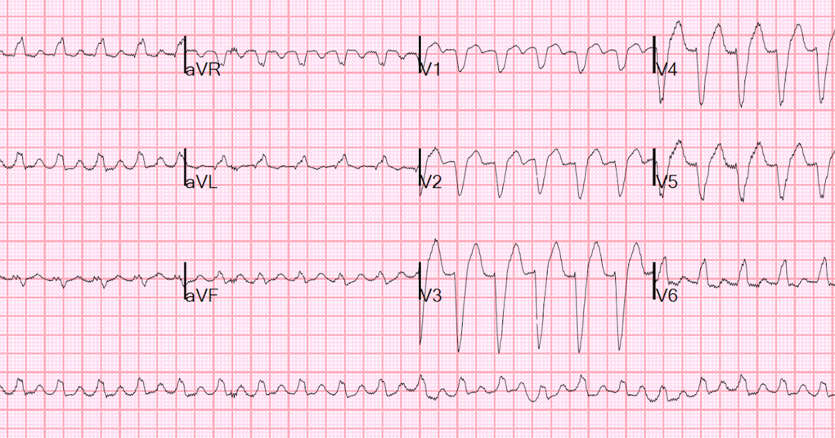 Dr. Smith's ECG Blog: Cardiogenic shock with wide complex tachycardia ...