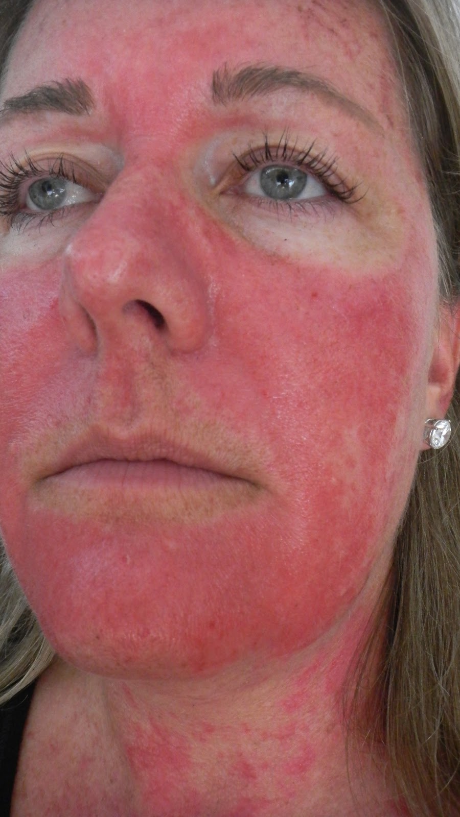 Efudex and Me 2013: 06/03/13