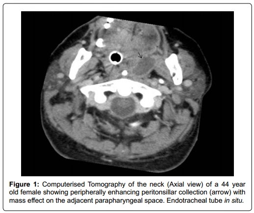 Microbi-blog-ogy!: Lemierre's Syndrome: A Case Report