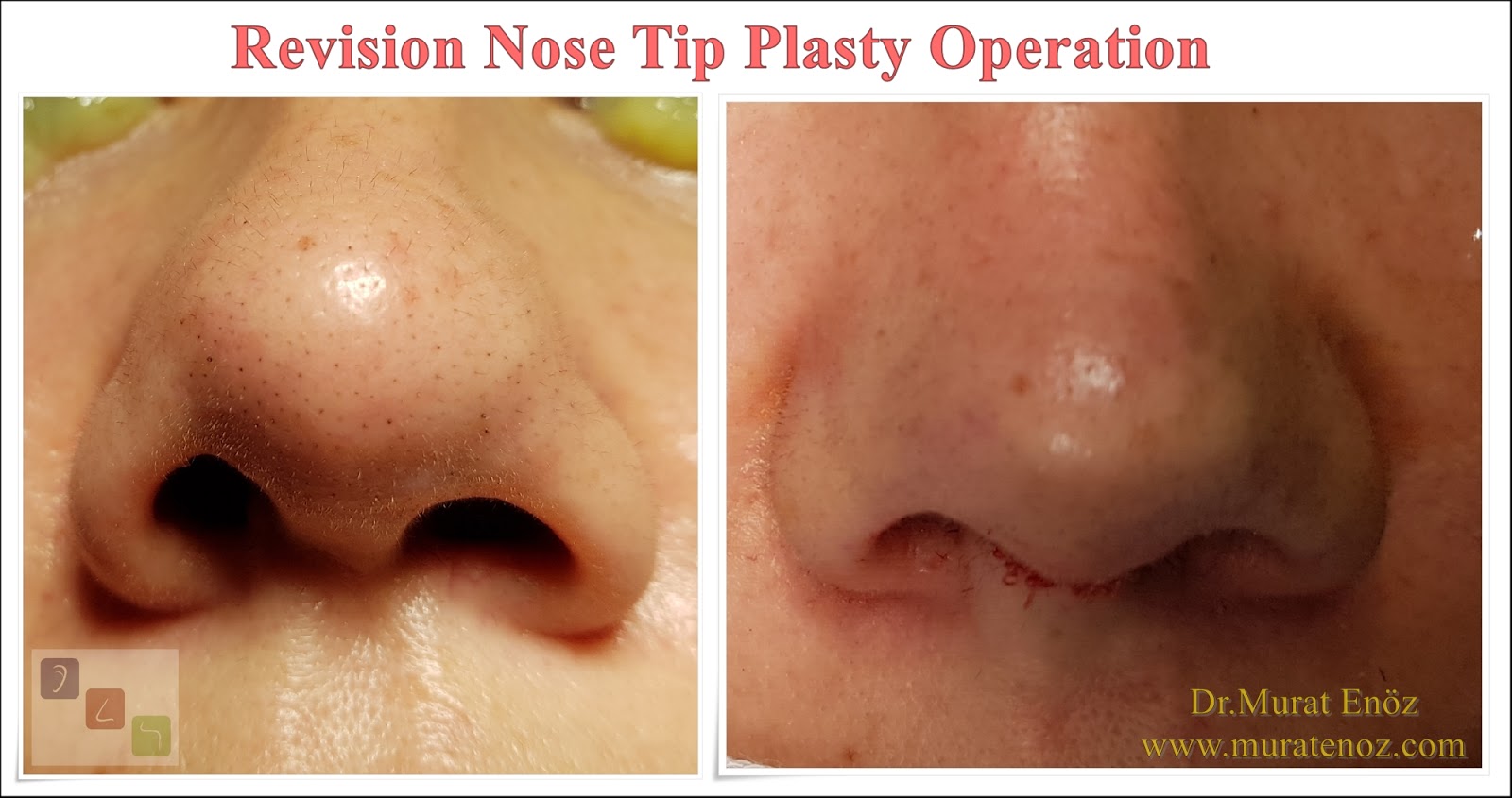 Problems That Can Be Seen After Nose Tip Plasty Operation