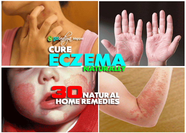 30 Natural Home Remedies for Eczema (Atopic dermatitis) in Kids ...