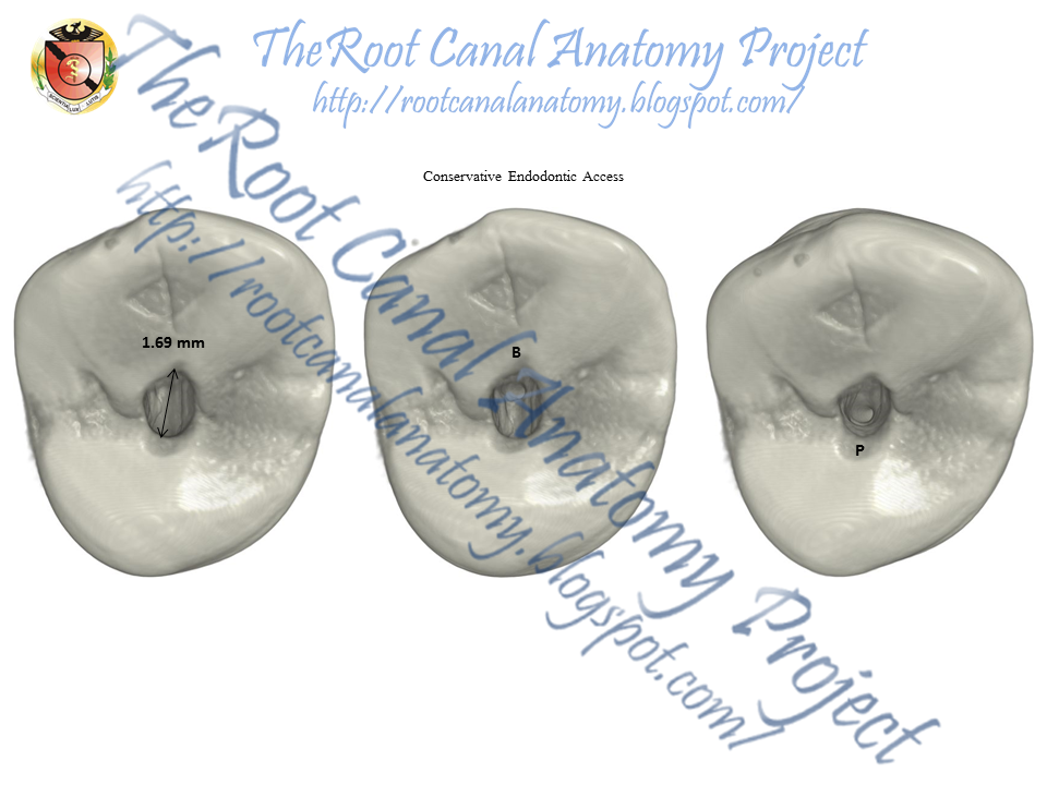 The Root Canal Anatomy Project: Conservative Endodontic Access ...