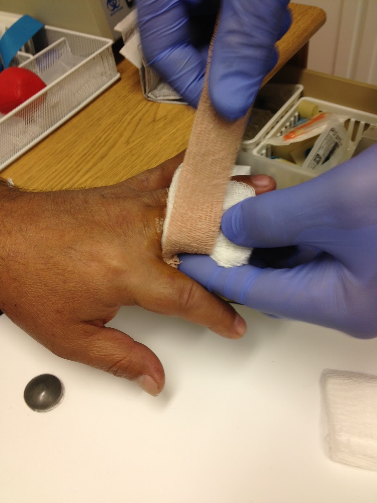 Crossing the Blood Brain Barrier: Ring-ectomy