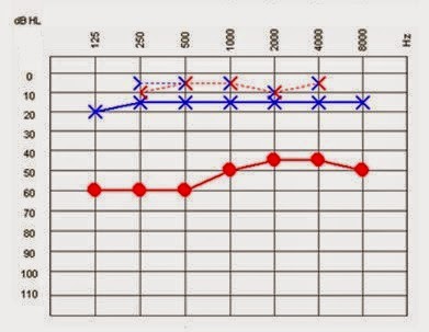 Audiometría: Diagnóstico Audiológico ~ Audiología didáctica para ...