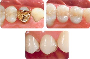TRATAMIENTOS DENTALES: Incrustaciones (Inlay u Onlay)
