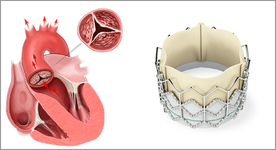 Medical Treatment Pictures-for Better Understanding: Aortic Valve ...