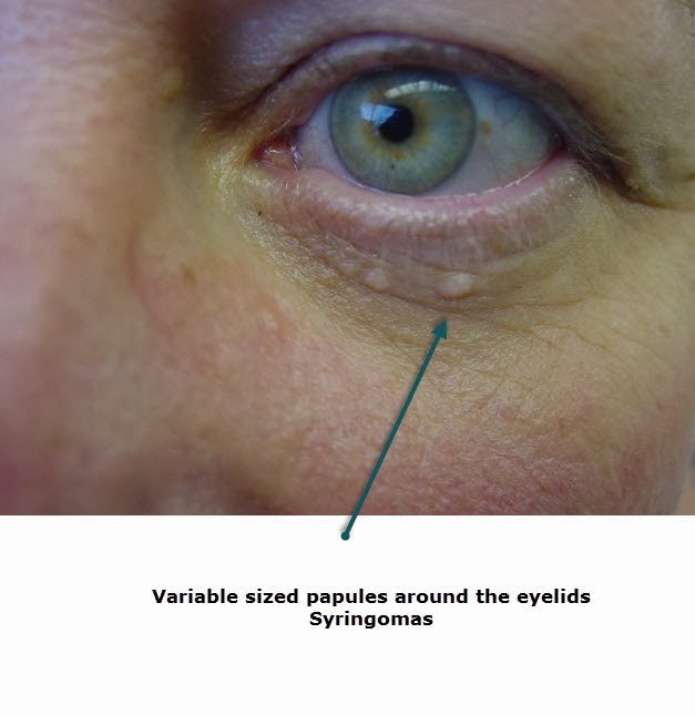 Dermpath Made Simple - Neoplastic: Syringoma