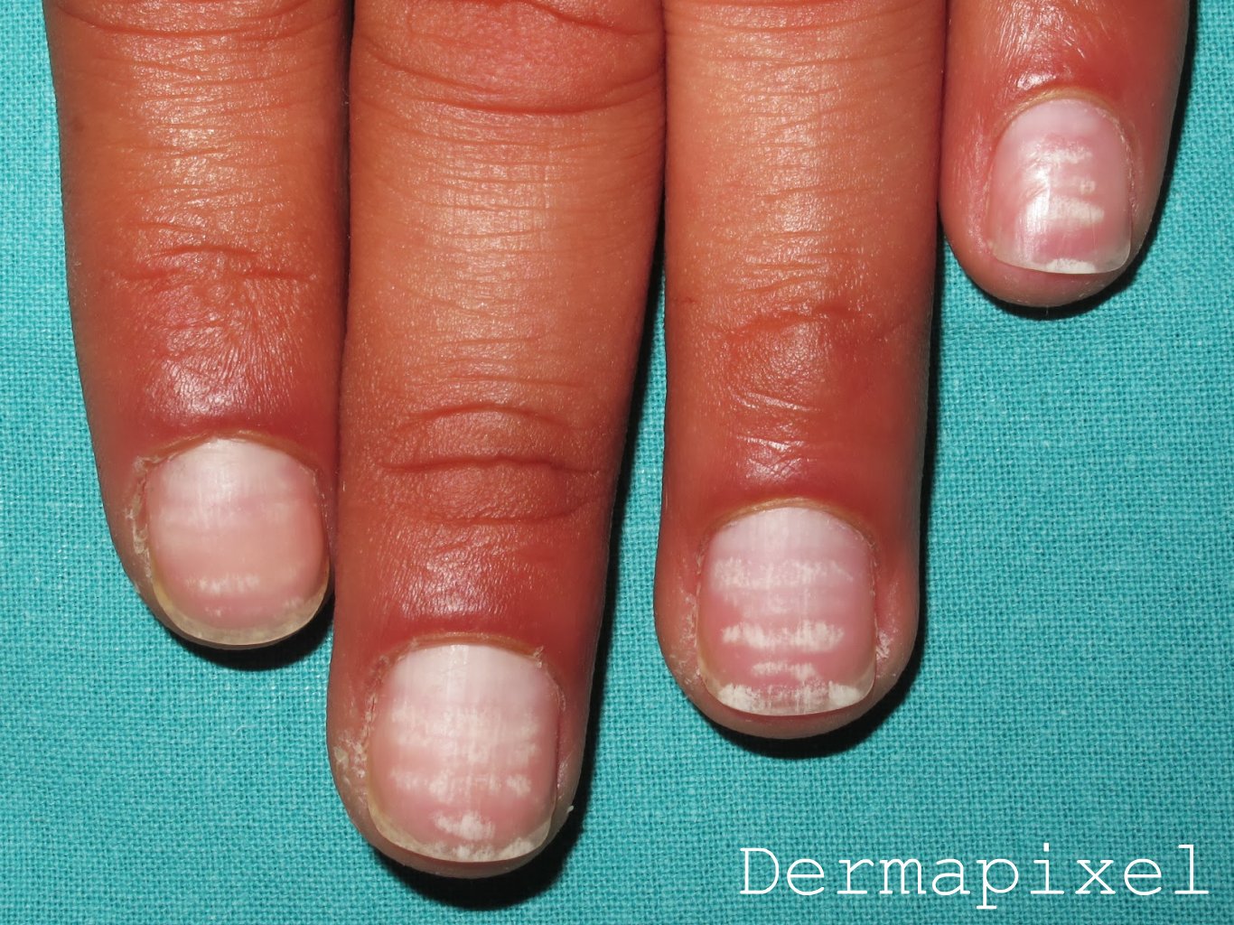 Dermapixel: Leuconiquia transversal: cuando las uñas son el espejo del alma