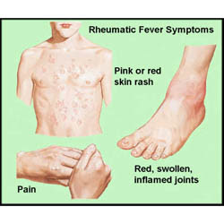 Prepare for Medical Exams : Rheumatic Fever - Long Case Study