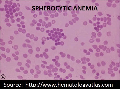 Lab Atlas: Spherocytic Anemia