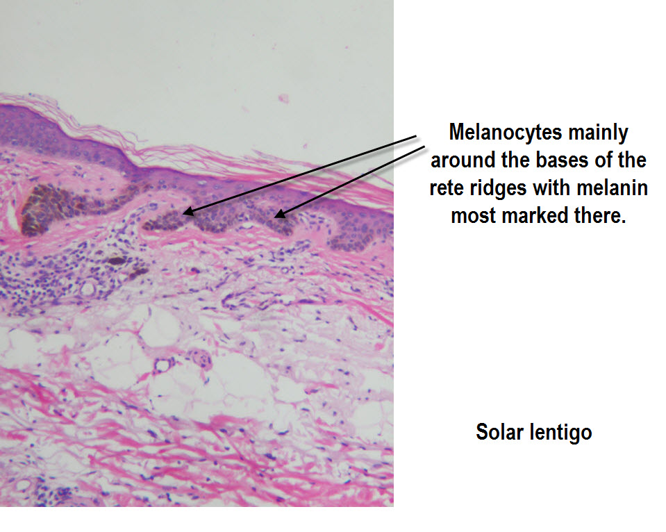Dermpath Made Simple - Neoplastic: Benign Pigmented Lesions - Solar ...