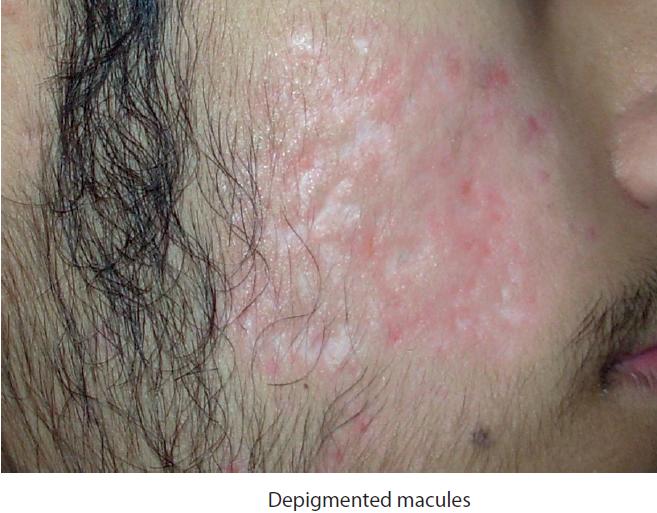 Morphological Types of Acne Scars - Treatment of Acne Scars