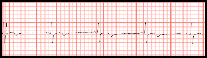 Practice EKG Strips