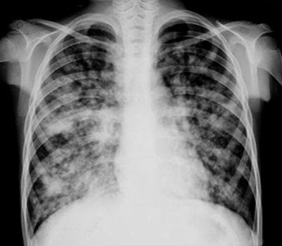 ENFERMEDADES INFECCIOSAS Y MICROBIOLOGIA MEDICA: DIAGNOSTICO DE LA TBC